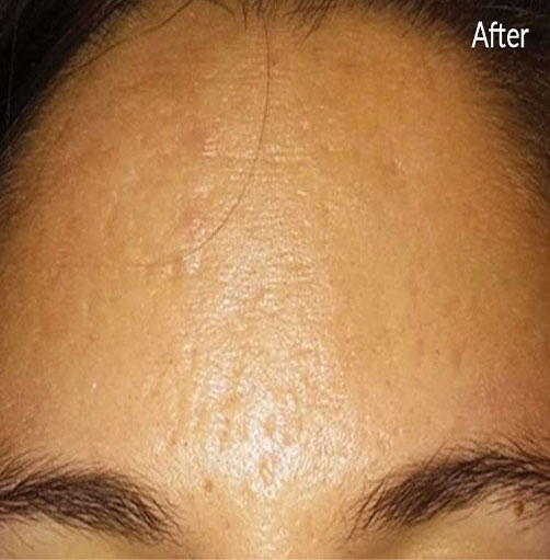 Microneedling - Belle Ame Med Spa